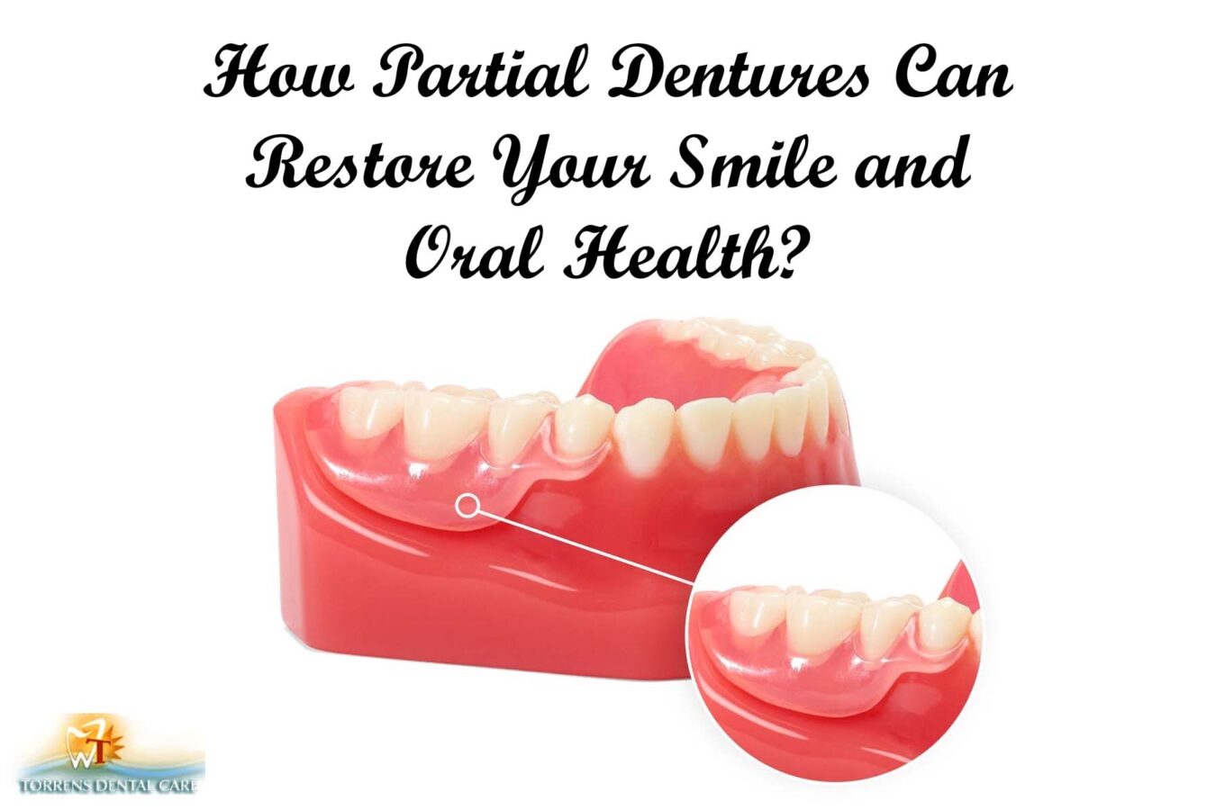 How Partial Dentures Can Restore Your Smile and Oral Health? - TORRENS ...
